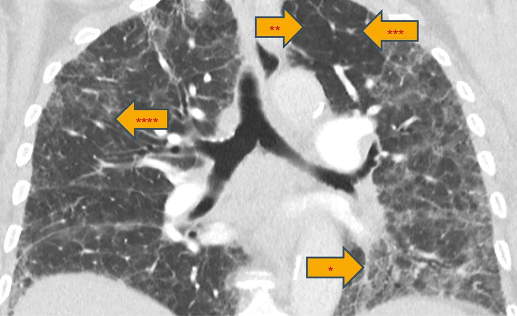 Progredientfibrosierende interstitielle Lungenerkrankungen – Diagnose - Pneumologie ...